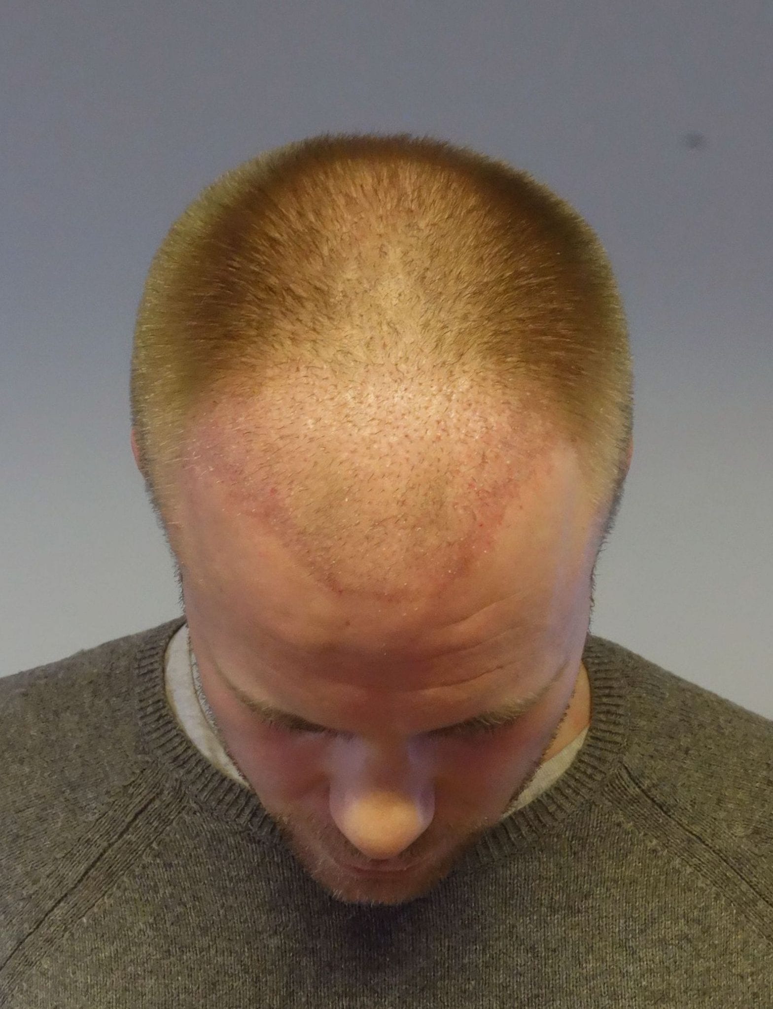 Post-procedure hair fall, the dormant phase and regrowth