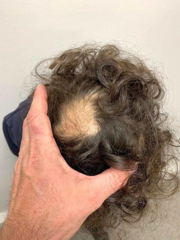 Three ways stress & anxiety can cause hair loss | MHR Clinic