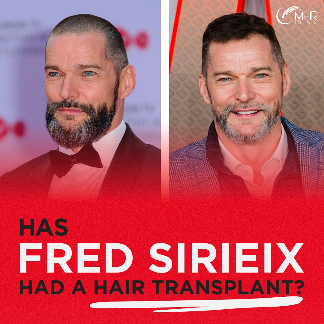 Fred Sirieix Addresses Hair Transplant Rumors: The Truth Revealed | MHR ...