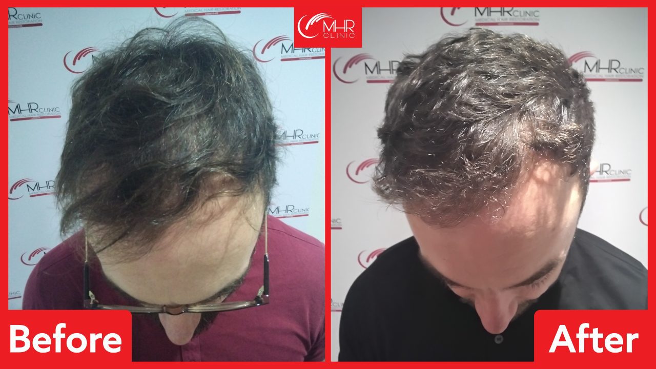 Luke Bailey | MHR Clinic UK | Hair Transplants in Manchester and Harrogate