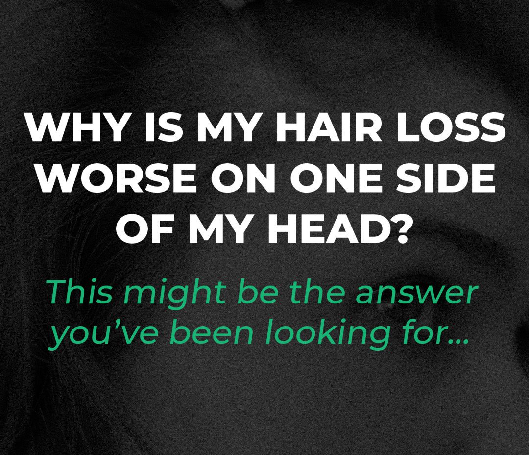 Why Is My Hair Loss on One Side of My Head? | MHR Clinic UK | Hair ...